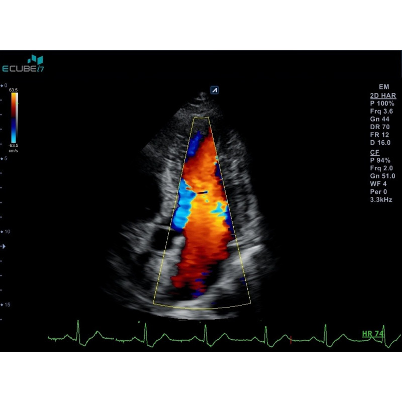 Alpinion E-Cube i7 portable ultrasound