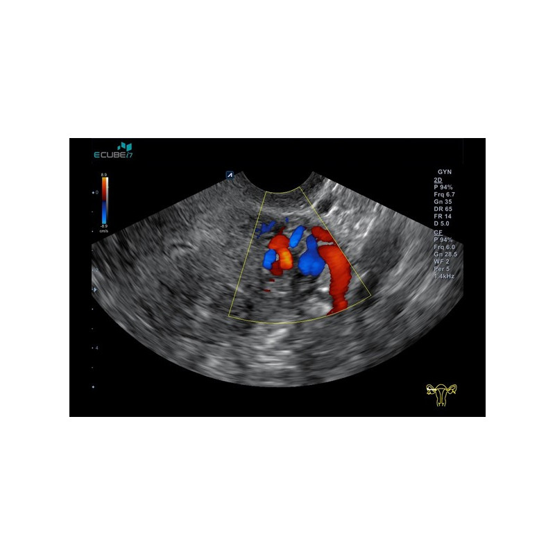 Alpinion E-Cube i7 portable ultrasound